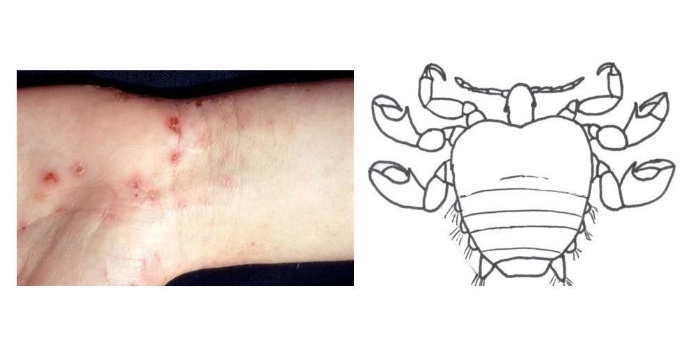 Da får du skabb og flatlus - innherred.no