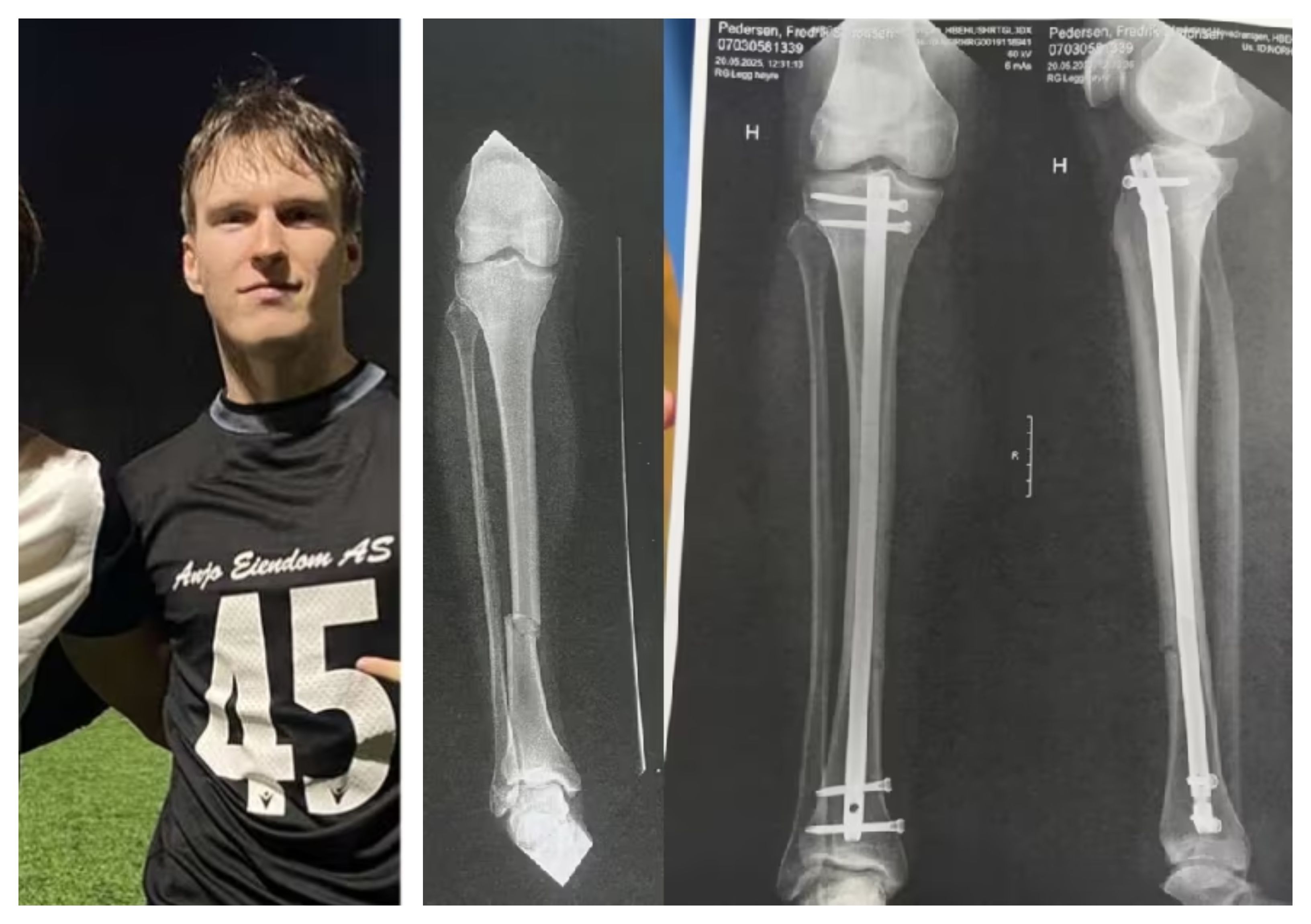 Fredrik (20) var hjemme på 17. mai-perm og skulle bare spille en kamp ...